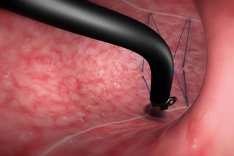 SUTURA ENDOSCÓPICA PARA REDUÇÃO DO ESTÔMAGO (Gastroplastia endoscópica ...
